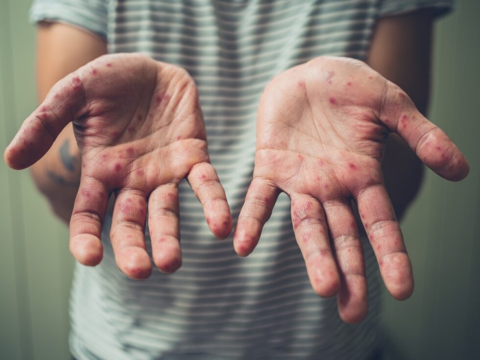 Project ECHO Launches Measles Response Series for Tribal and Urban ...
